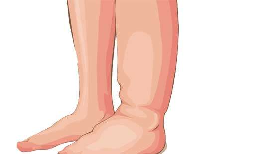 What does a swelling in the legs indicate? - Medicine | Daily Mirror
