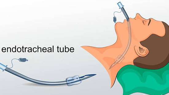 Hospitals run out of endotracheal tubes for new-born babies - Latest ...