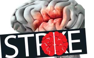 Stroke Preventable with early detection - Medicine | Daily Mirror