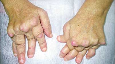 Rheumatoid Arthritis Arthritis Dealing with red hot joints - Medicine ...