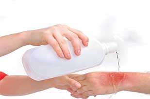 How to manage acute burn injuries - Medicine | Daily Mirror